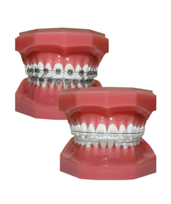 Damon Braces for Faster Treatment and Customized Orthodontic Solutions
